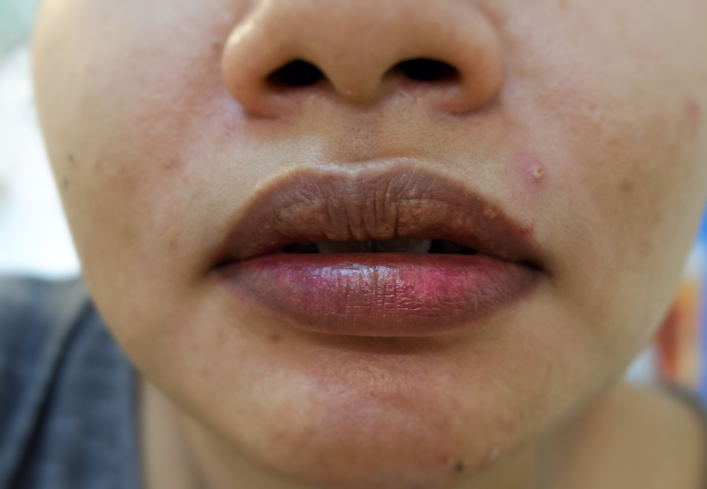 Laser Treatment for Dark Lips: Safe and Effective Pigmentation Removal ...